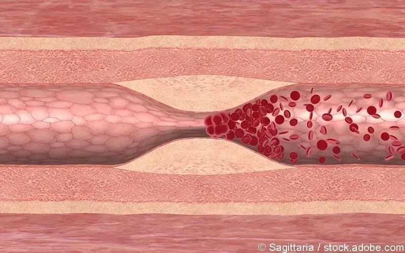 Embolie Pulmonaire Radiographie Thoracique