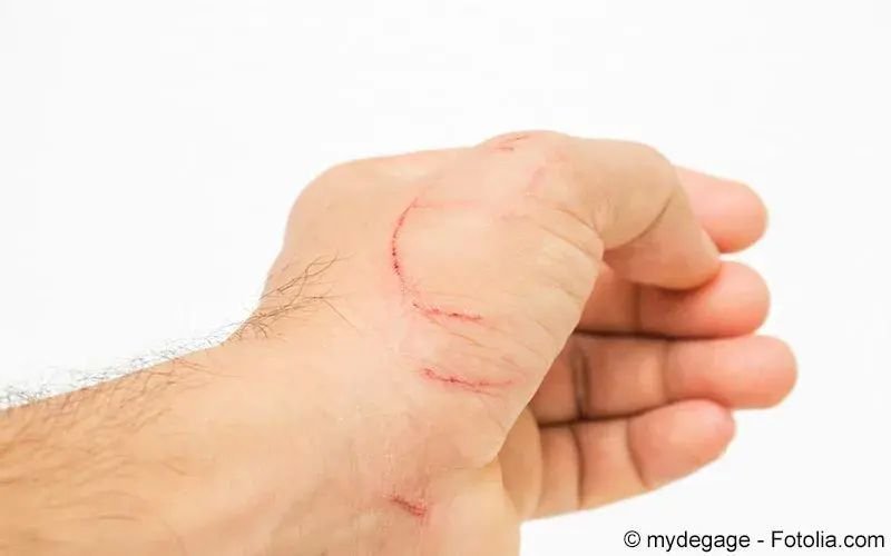 Katzenbiss Muss Ich Zum Arzt