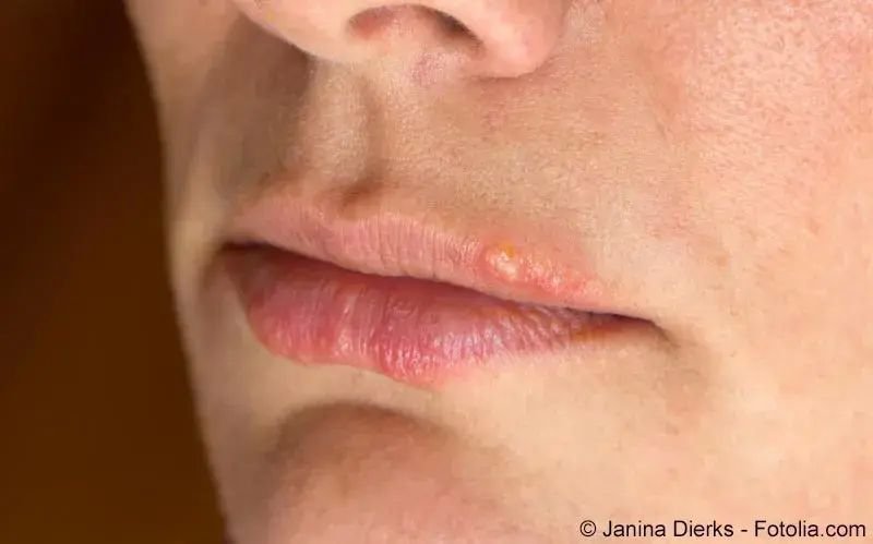 Lippenherpes