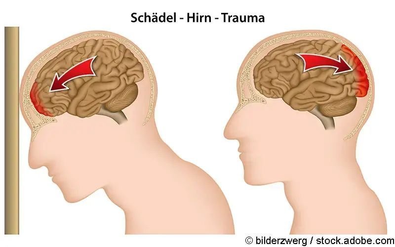 Schädel Hirn Trauma Epilepsie